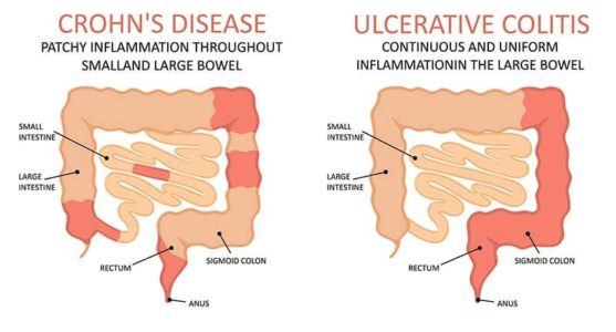 Crohn's Disease | An Ultimate Guide (Symptoms, Diet, Causes, Treatment)