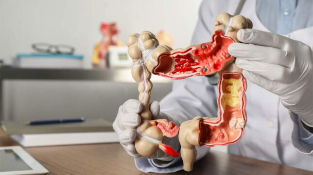 Tests For Colon Cancer Without a Colonoscopy: What You Should Know